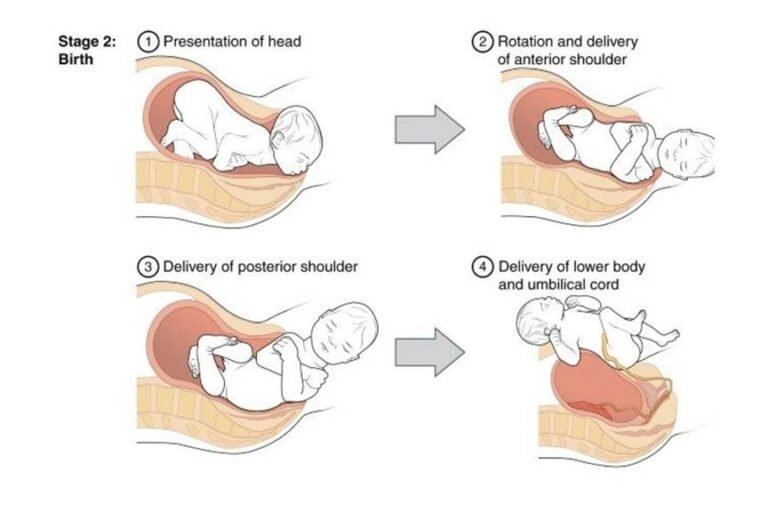 DME.111 Second Stage of Labour – Nurses Online Discussion
